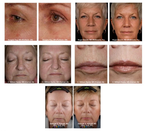 SmartXide DOT CO2 Laser – Yardley Dermatology Associates